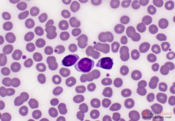 B Prolymphocytic Leukaemia - LearnHaem | Haematology Made Simple
