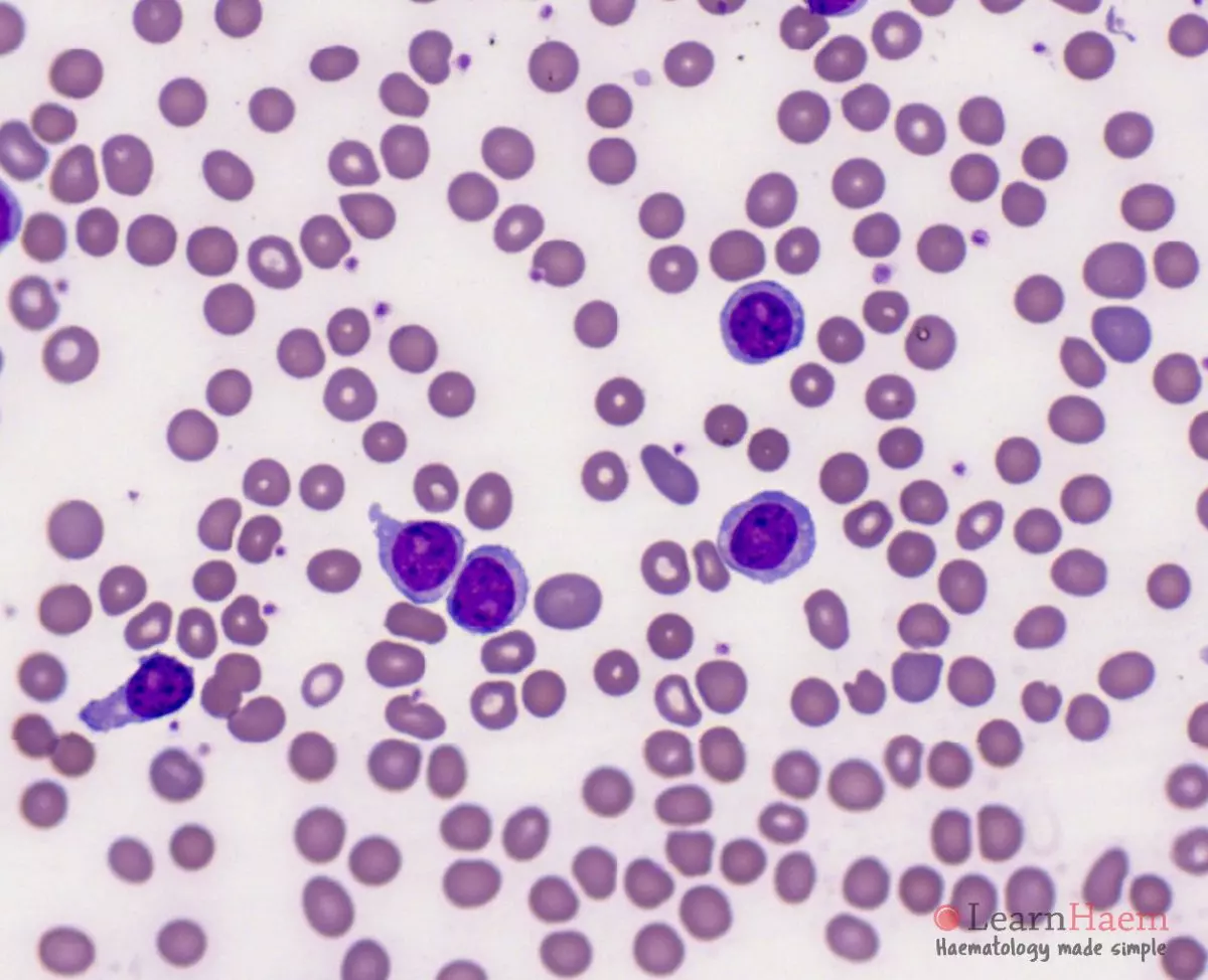 B Prolymphocytic Leukaemia - LearnHaem | Haematology Made Simple