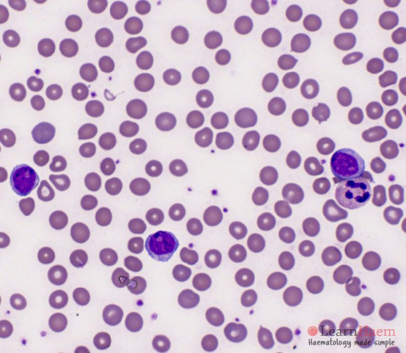 B Prolymphocytic Leukaemia - LearnHaem | Haematology Made Simple