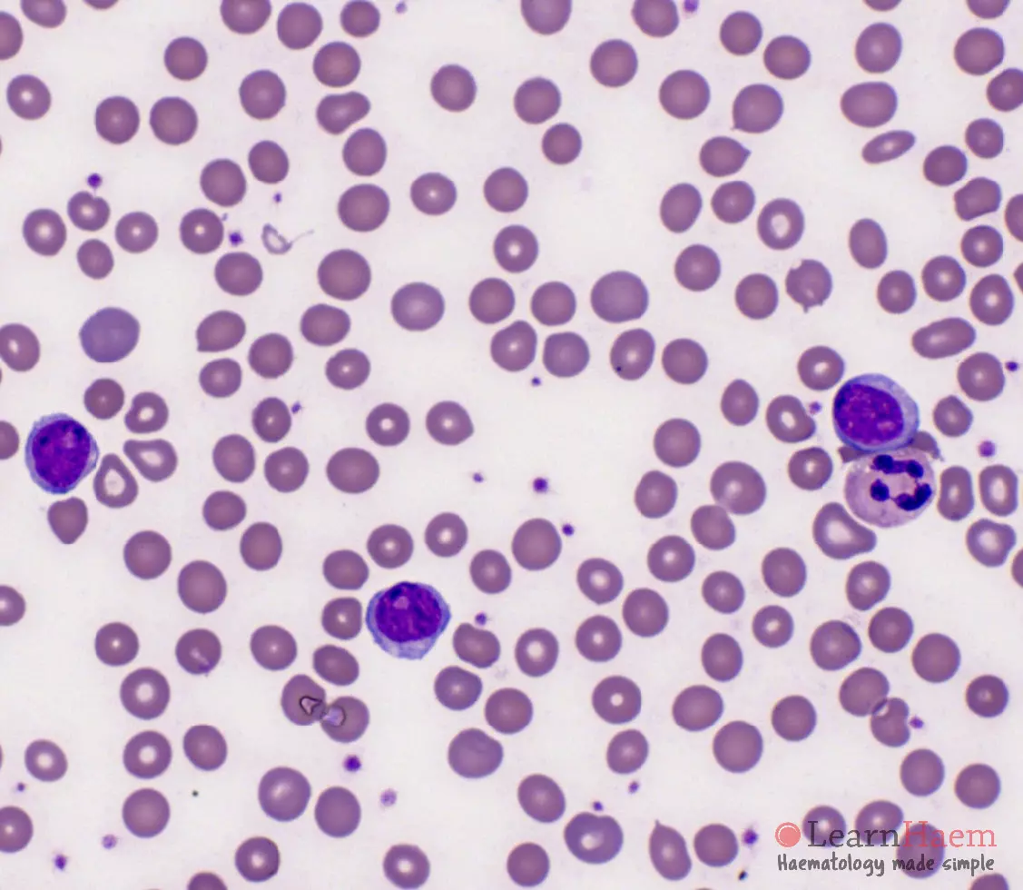 B Prolymphocytic Leukaemia - LearnHaem | Haematology Made Simple
