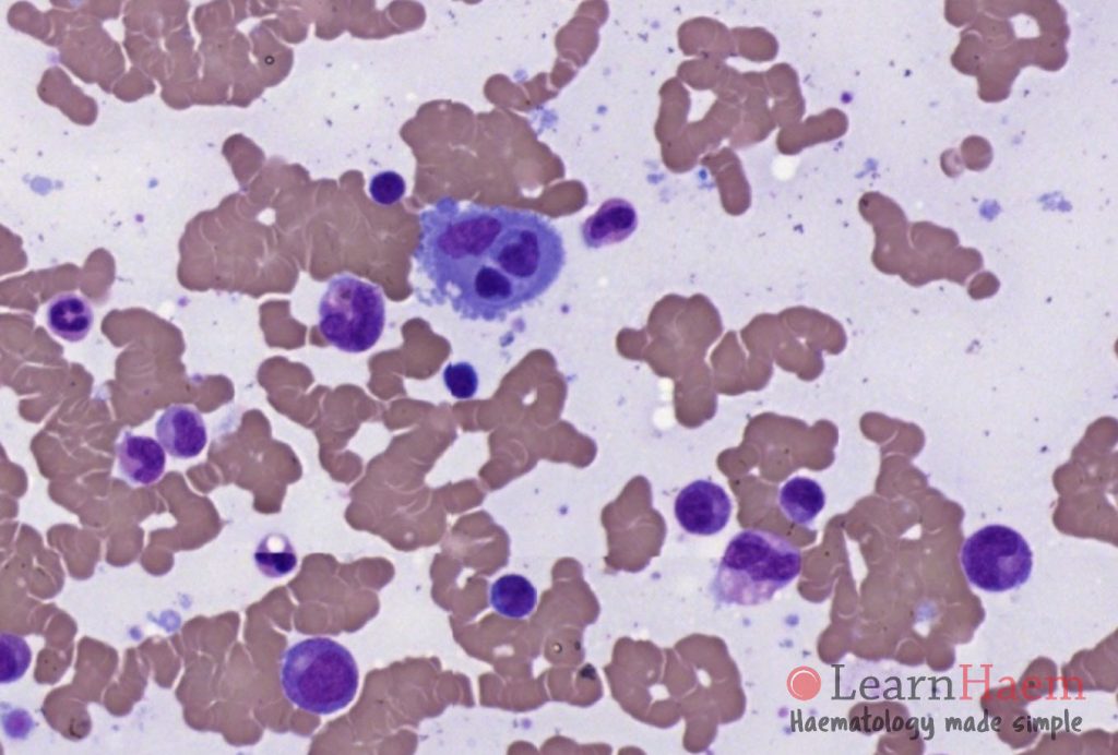 Haemophagocytic Lymphohistiocytosis - LearnHaem | Haematology Made Simple