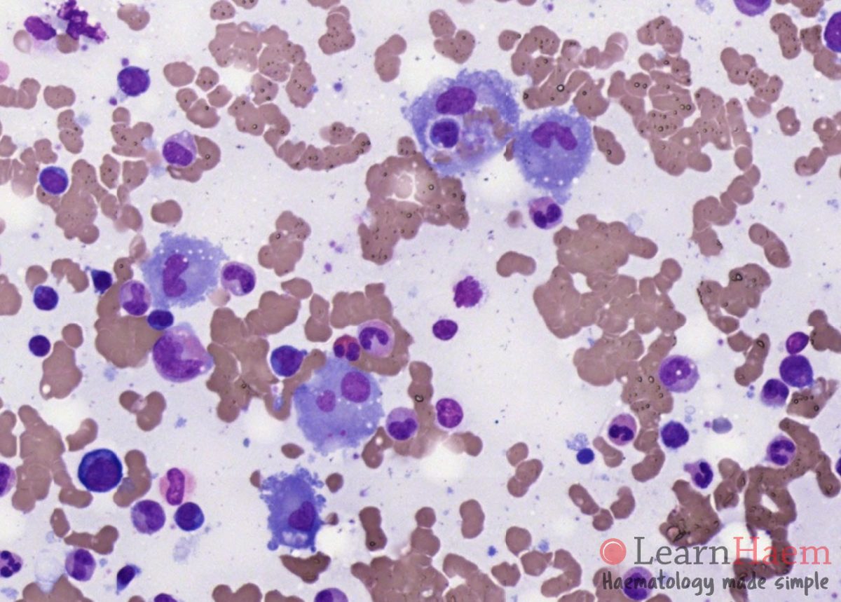 Haemophagocytic Lymphohistiocytosis - LearnHaem | Haematology Made Simple