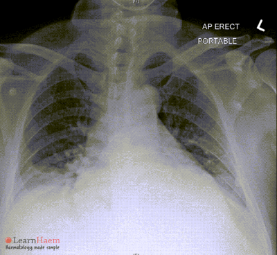 Beginner Test 1 - LearnHaem | Haematology Made Simple