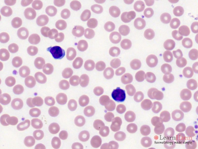 T Prolymphocytic Leukaemia - LearnHaem | Haematology Made Simple