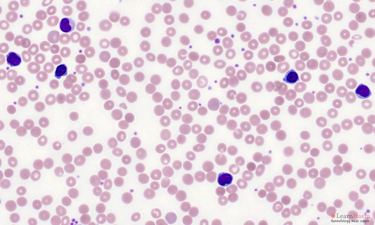 T Prolymphocytic Leukaemia - LearnHaem | Haematology Made Simple