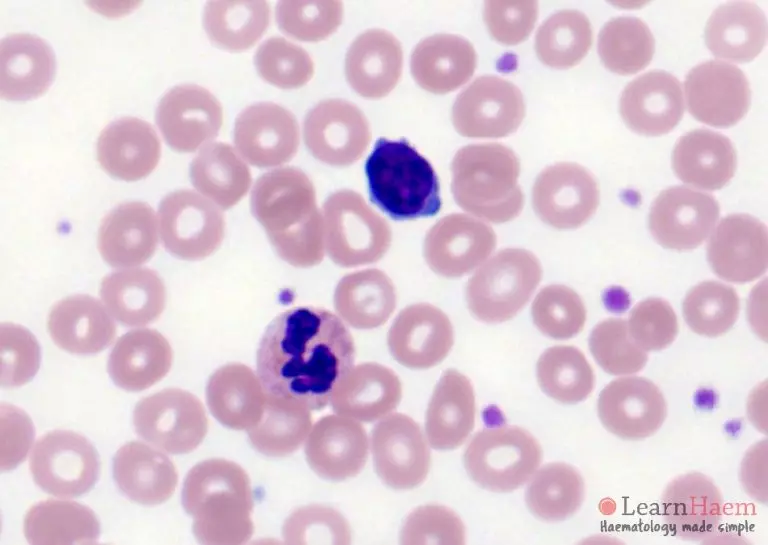 T Prolymphocytic Leukaemia - LearnHaem | Haematology Made Simple