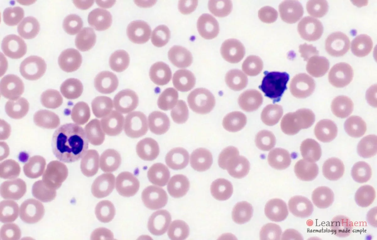 T Prolymphocytic Leukaemia - LearnHaem | Haematology Made Simple