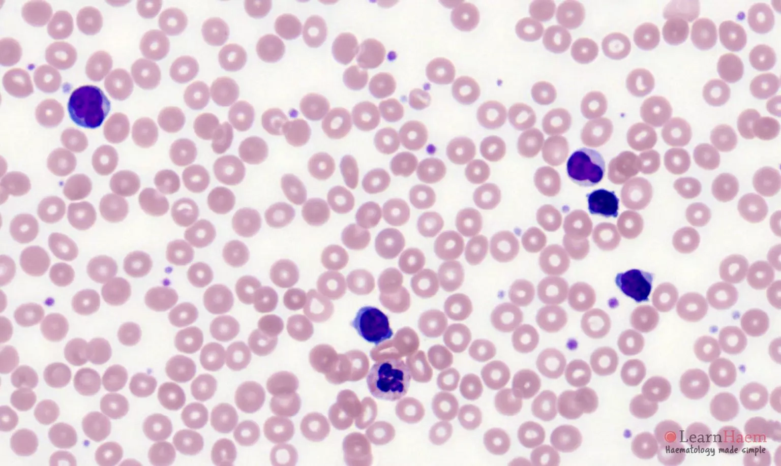 T Prolymphocytic Leukaemia - LearnHaem | Haematology Made Simple