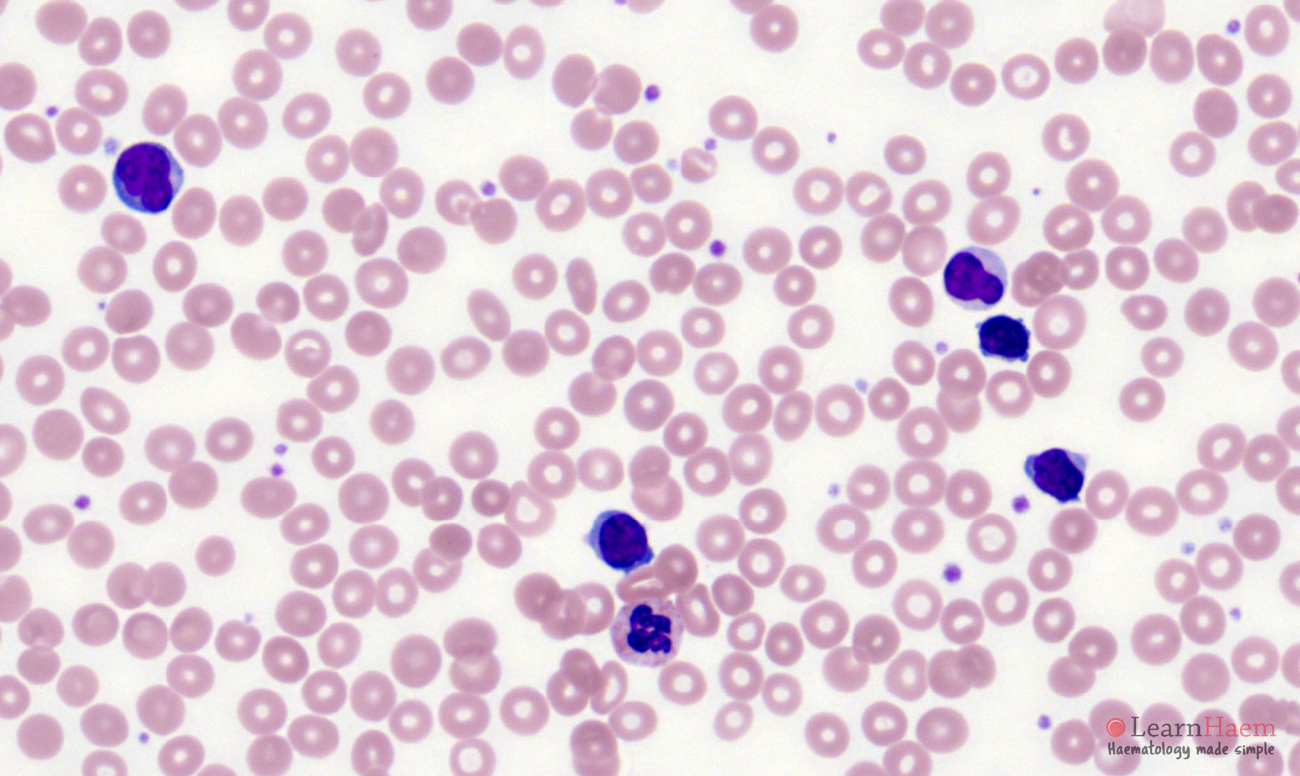 T Prolymphocytic Leukaemia - LearnHaem | Haematology Made Simple