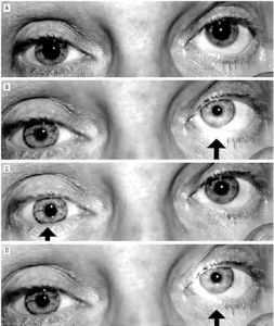 Relative Afferent Pupillary Defect (Marcus-Gunn Pupil) - MRCP PACES ...
