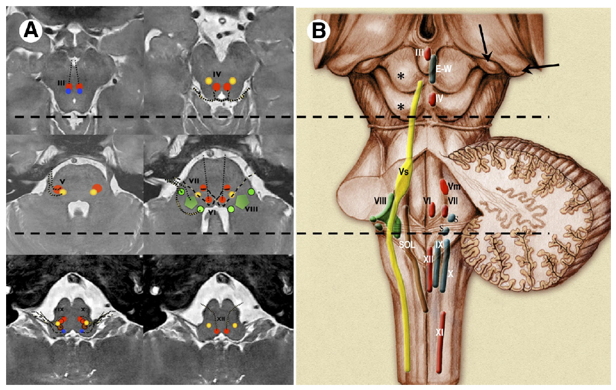 Brainstem Syndromes - MRCP PACES - LearnHaem | Haematology Made Simple